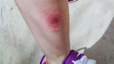Hardlopen Nl Wat Doe Je Bij Een Tekenbeet