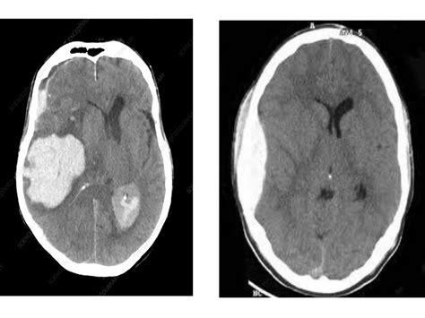 Intra Cranial Hemorrhages Agp Pptx