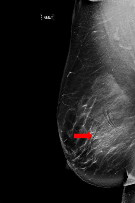 Partial Mastectomy Lumpectomy Utilizing Savi Scout For A Nonpalpable Papilloma Journal Of