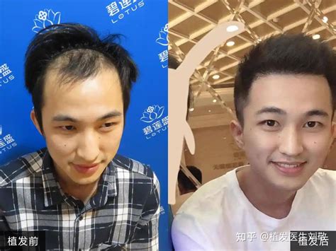 二十岁出头，脱发很严重，怎么办？ 知乎