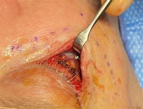 Technical Strategies Placement Of Extended Tear Trough Implants For
