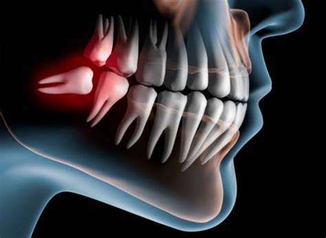 Cómo aliviar el dolor de muela del juicio de forma efectiva Dentas Tool