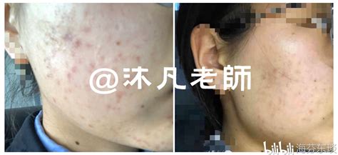 男生干性皮肤如何祛痘印，如何正常健康的祛痘 哔哩哔哩