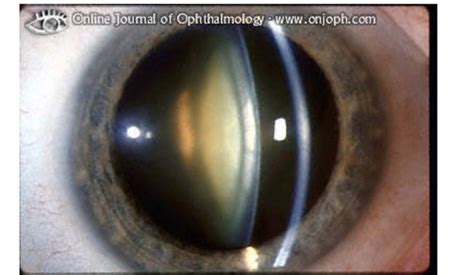 Ocular Disease Lens Disorders Flashcards Quizlet