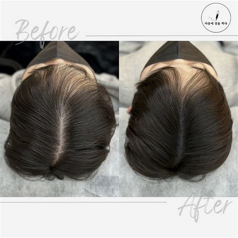 광주두피문신 마음에점을찍다 두피문신 가격 광주smp 남자탈모 여자탈모 광주탈모 가르마탈모 정수리탈모