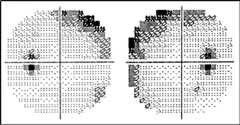 Humphrey Visual Fields Show Nasal Defects And Enlarged Blind Spots In