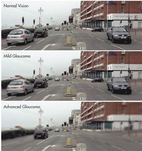 Symptoms Of Glaucoma Learn About Glaucoma