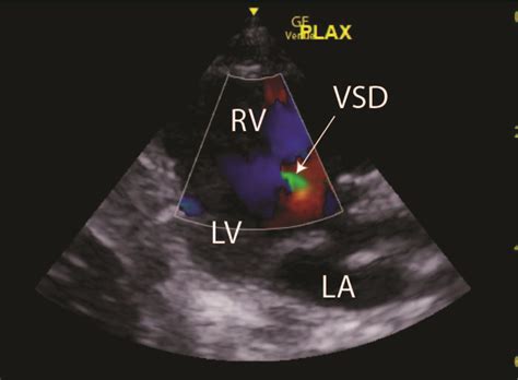Vsd In A 3 Month Old Critical Care Sonography