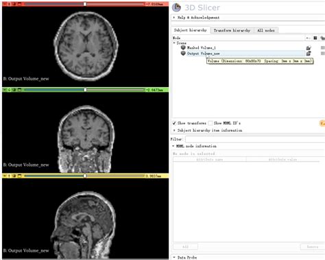 用3d Slicer 对核磁结构影像做降维处理3dslicer怎么改变体素 Csdn博客