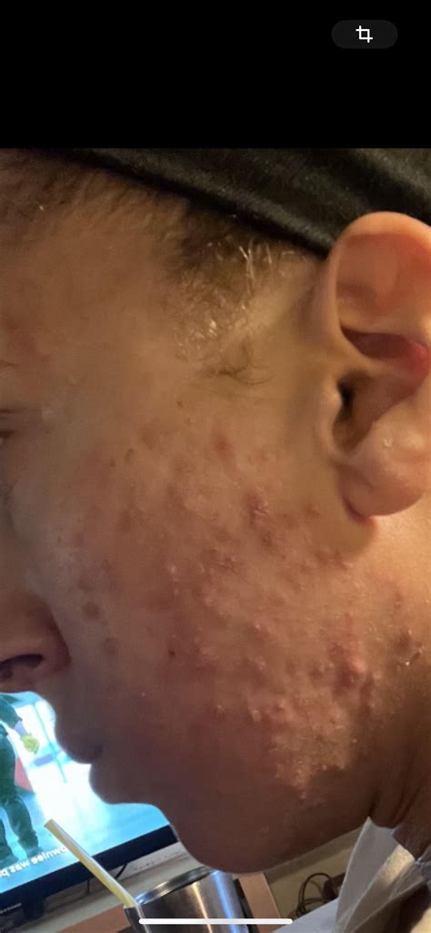 Accutane Vs Amnesteem R Acne