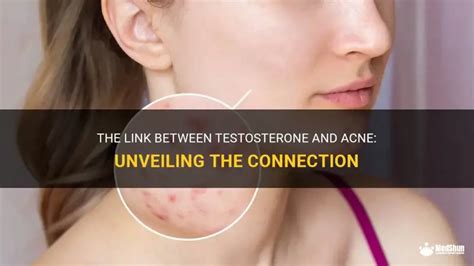 The Link Between Testosterone And Acne Unveiling The Connection Medshun