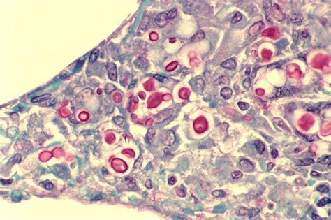 Cryptococcus Neoformans Wikipedia