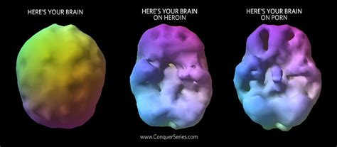 Spect Scan Brain