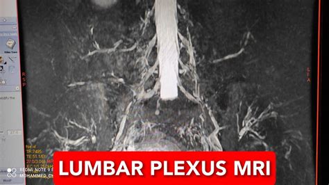 Lumbar Plexus Mri Protocol