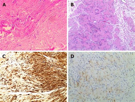 Figure 1 From Spinal Intraosseous Schwannoma Without Spinal Canal And
