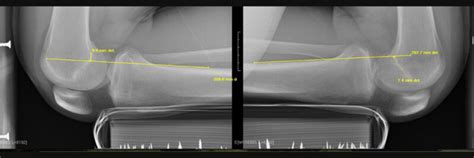 Pcl Stress Radiograph Technique Edina Egan Mn