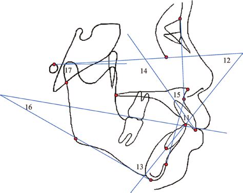 Angular Measurements Used In Study Continued 11 Interincisal Angle