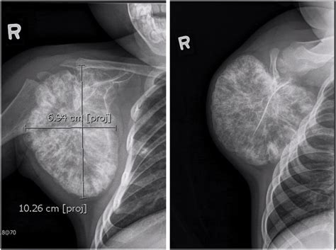 X Ray Imaging Of The Scapular Lesion Note The Size And Rib Deformity