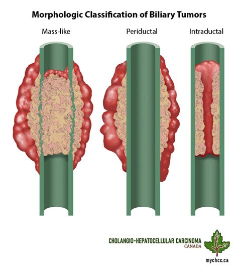 Cholangio Hepatocellular Carcinoma Canada