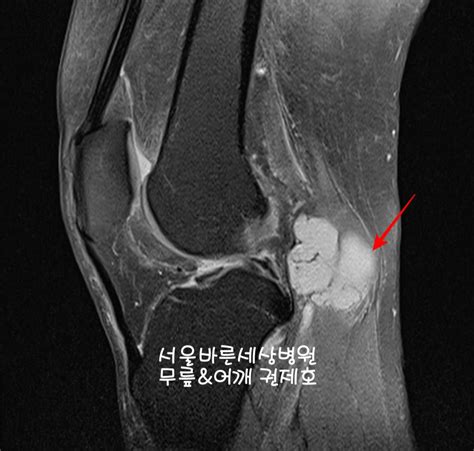 무릎뒤쪽통증 무릎물혹 Cyst 베이커씨낭종과 다른 슬와낭종 네이버 블로그
