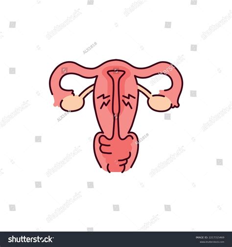 Endometrial Hyperplasia Color Line Icon Gynecology Stock Vector