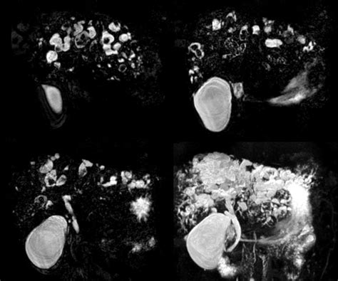MRCP Images Of A Patient With Oriental Cholangiopathy Showing The Download Scientific Diagram