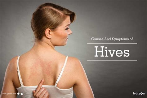 Causes And Symptoms Of Hives By Dr Priyanka Pal Mantri Lybrate