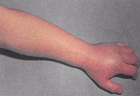 Acute Effects Erythema And Skin Edema Radiation Emergency Medical Management