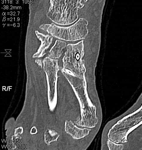 Percutaneous First Metatarsocuneiform Joint Arthrodesis Treatment Of Severe Recurrent Forefoot