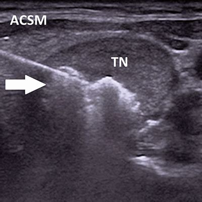 Radiofrequency Ablation Of Thyroid Nodules Endocrine Society