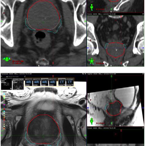 Contour Of The Prostatic Plexus As An Organ At Risk During The