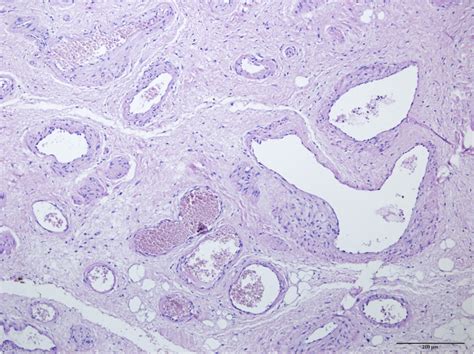 Biopsy Result Of The Original Vm Lesion Hematoxylin And Eosin Staining