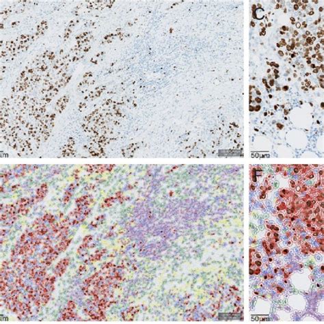 Ckmnf116 A And Aligned Ki67 B Immunohistochemistry Stained Tumor Download Scientific