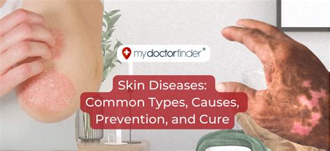 Skin Diseases Common Types Causes Prevention And Cure