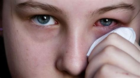 बड़े तेजी से फैल रहा है Eye Flu जाने क्या है Eye Flu और इससे कैसे बचें