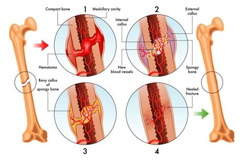 How Long Does It Take For A Fracture To Heal Orthopaedics Toronto
