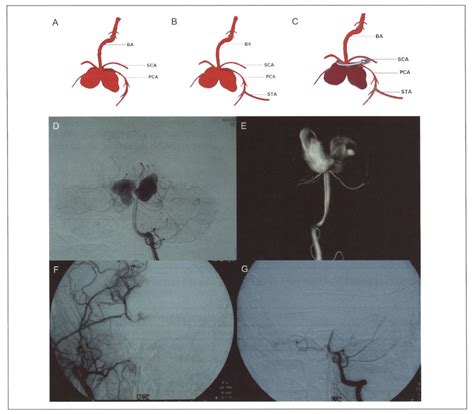 Patient 2 Illustration Of Basilar Bifurcation Aneurysm A B C