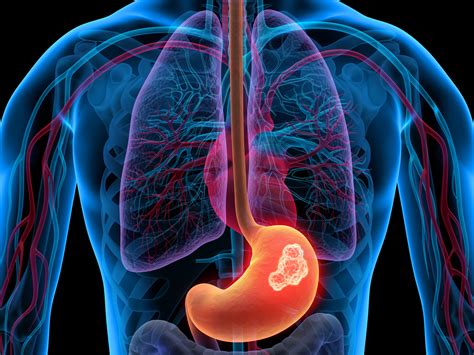 Stomach Cancer