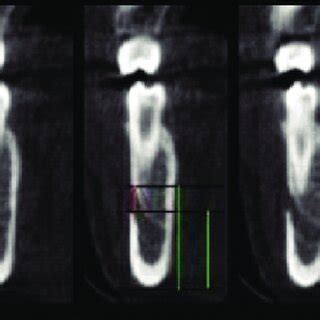 Tangents Marked Black Lines To Show The Superior Margin And Inferior Download Scientific