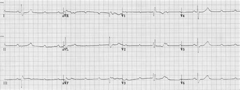 Trifascicular Block • Litfl • Ecg Library Diagnosis