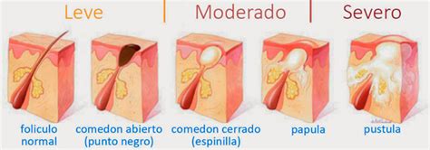Acné y sus Causas Mentes al Desnudo