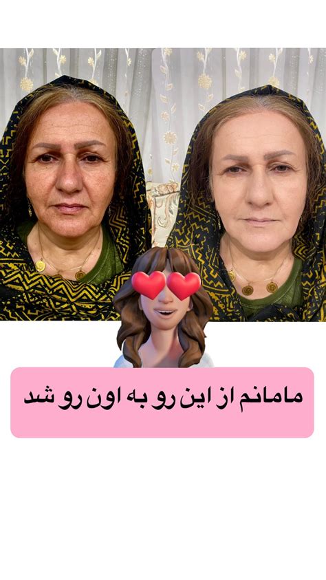 ‎لی لی بیوتیمراقبت پوستروتین پوستیلک جوشجای جوش‎ ‎یکی بخر ۵ تا