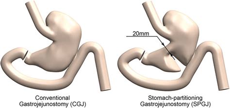 Frontiers Gastric Emptying Performance Of Stomach Partitioning