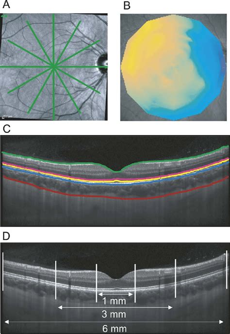A Radial Line Scan Pattern Used For Sd Oct Imaging B Choroid