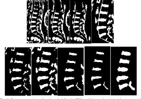 Figure 1 From Classification Of Lumber Spine Disc Herniation Using Machine Learning Methods