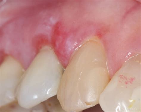 Lichen Planus Gums Oral Lichen Planus Bild Kaufen 13258734