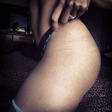 The Dirty Truth About Stretch Marks Diary Of A Fit Mommy