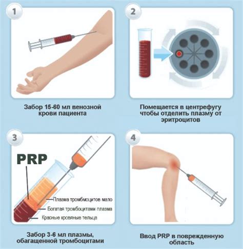 Prp терапия в Уфе ПРОГРЕССИВНАЯ МЕДИЦИНА