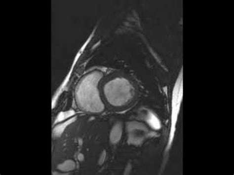 Cardiac Mri Short Axis