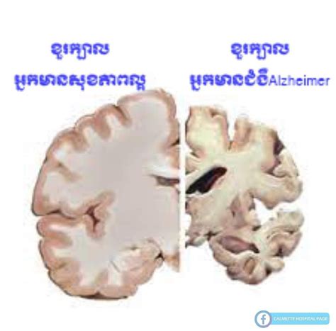 កង្វះវីតាមីនd និងផលប៉ះពាល់ទៅលើខួរក្បាល និងប្រព័ន្ធប្រសាទ សារព័ត៌មាន